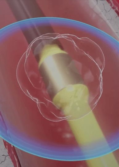 Taking A Pulse Check In Complex Calcified Vessels - Shockwave Medical