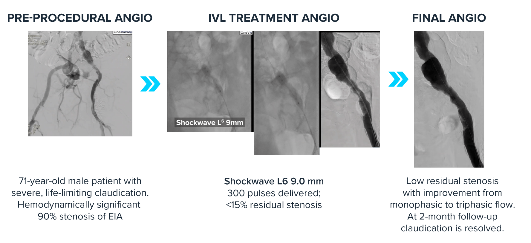 Shockwave L6 - Shockwave Medical