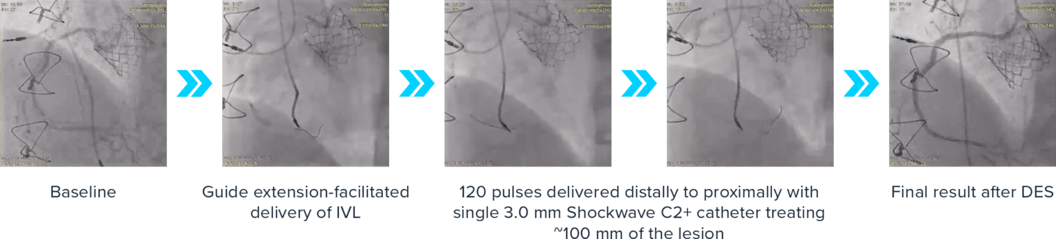Shockwave C2+ - Shockwave Medical