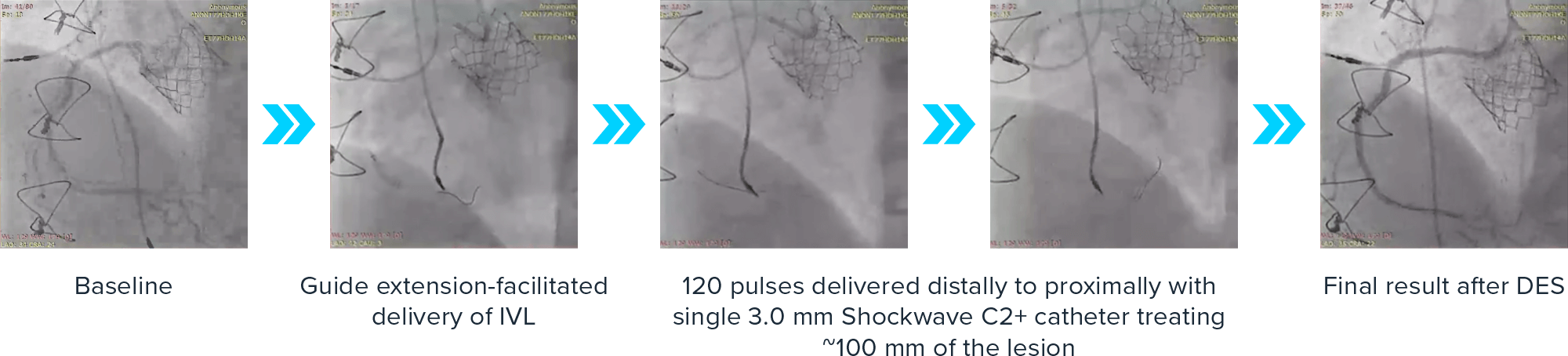 Shockwave C2+ - Shockwave Medical