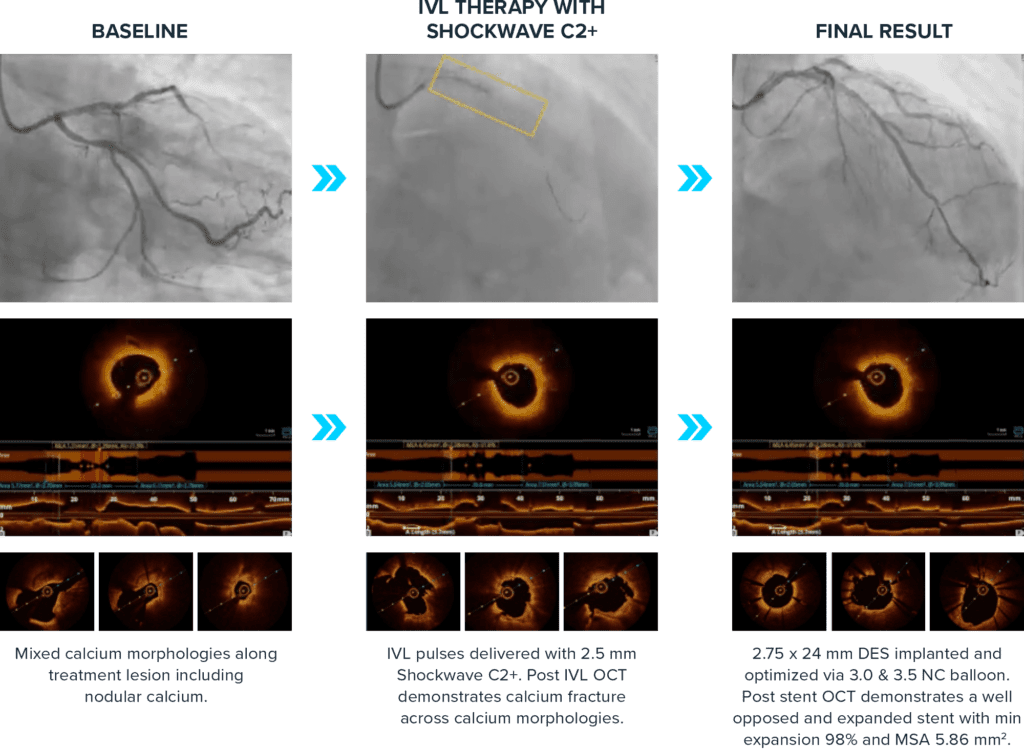 Shockwave C2+ - Shockwave Medical