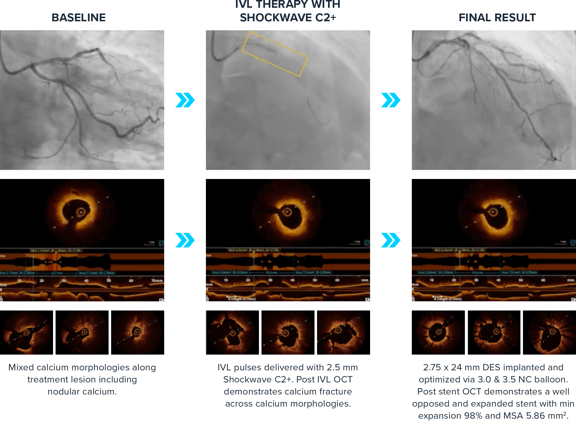 Shockwave C2+ - Shockwave Medical