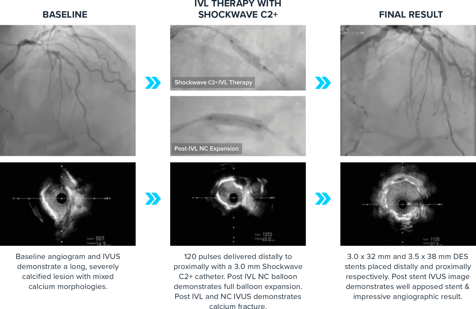 Shockwave C2+ - Shockwave Medical
