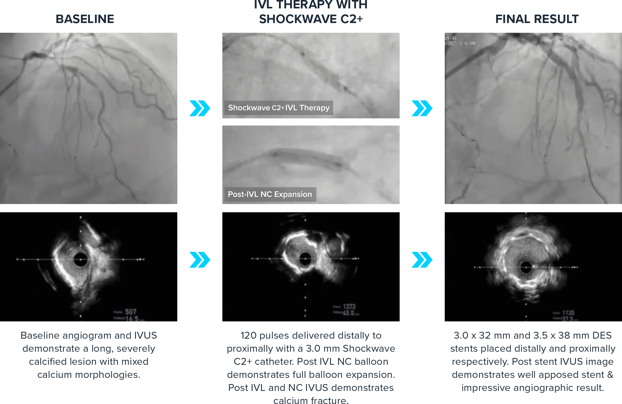 Shockwave C2+ - Shockwave Medical