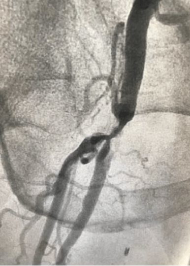High Risk CFA And Profunda Treatment - Shockwave Medical