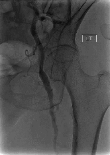 Transfemoral Impella In Calcified Iliacs - Shockwave Medical