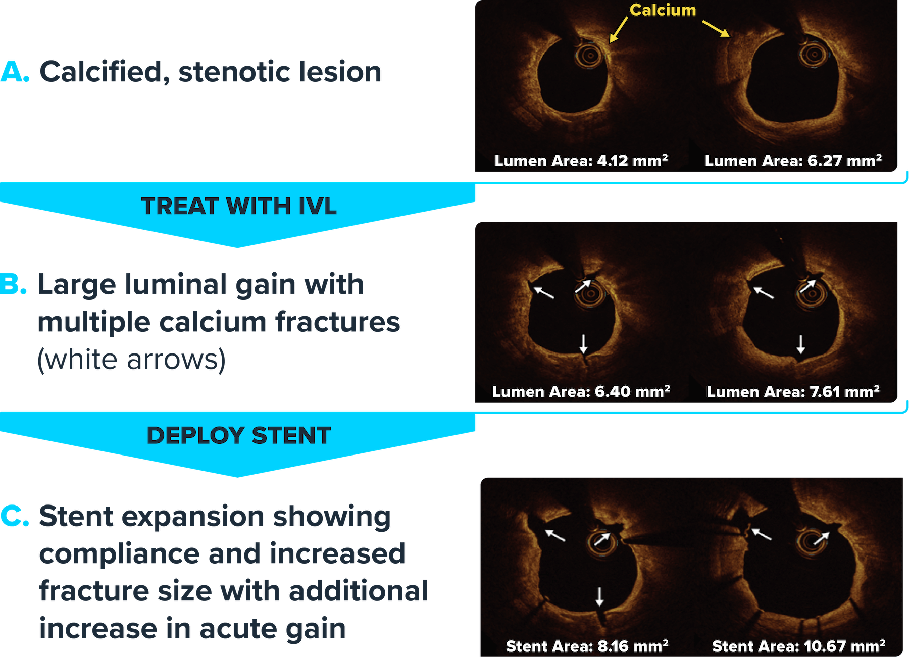 DISRUPT CAD I - Shockwave Medical
