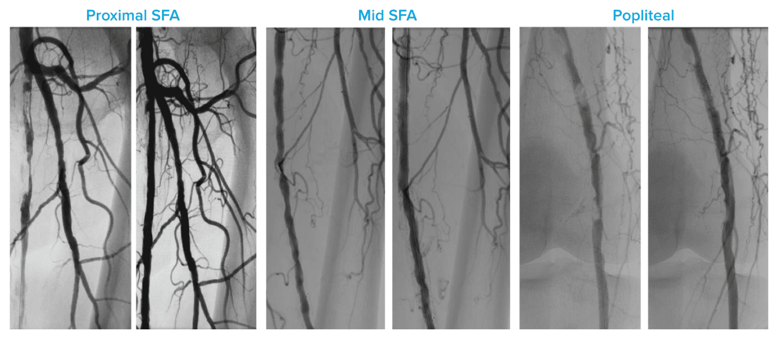 Diffuse Calcification Of SFA And Popliteal - Shockwave Medical