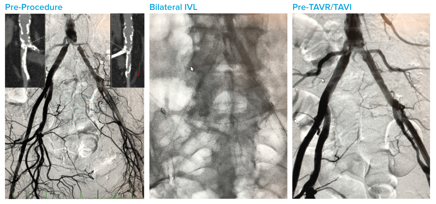 Pre-TAVR/TAVI IVL In Calcified Iliacs - Shockwave Medical