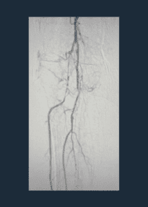 Shockwave M5+ - Shockwave Medical