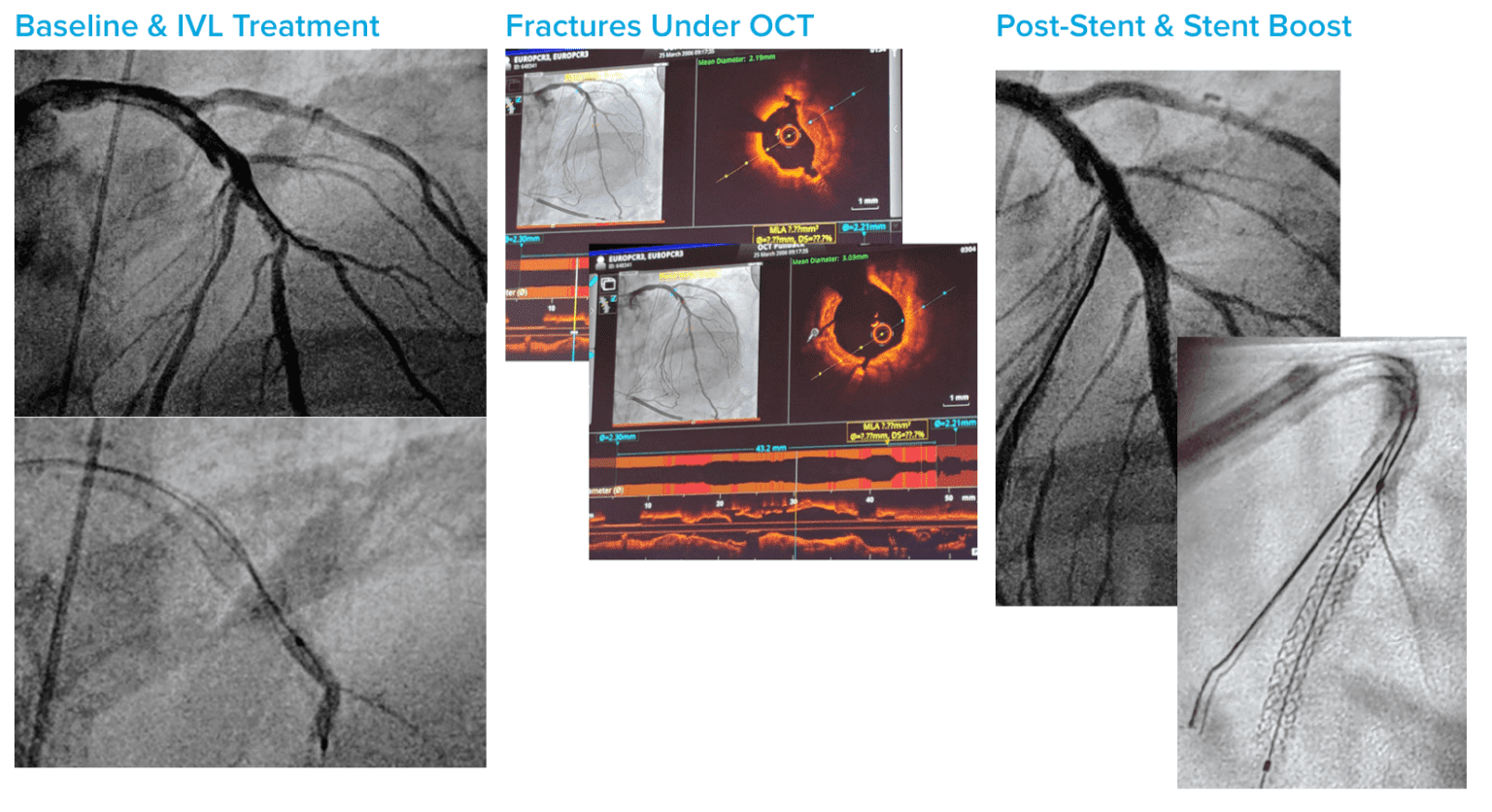 Diffuse LAD Case Featured In Main Arena At PCR18 - Shockwave Medical