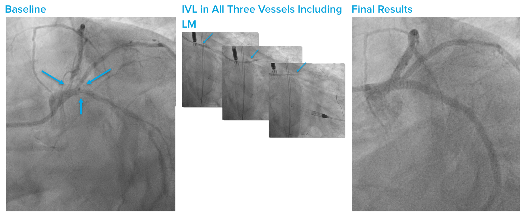 Heavily Calcified LM Trifurcation With Hemodynamic Support - Shockwave ...