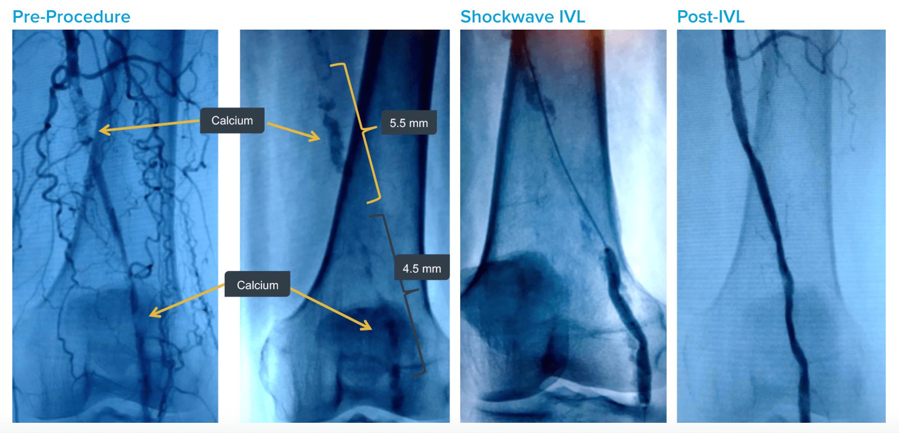 Heavily Calcified Popliteal Occlusion - Shockwave Medical