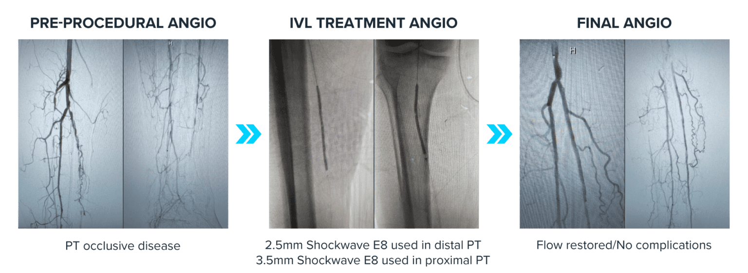 Dr. Mazin Foteh's E8 Case - Shockwave Medical