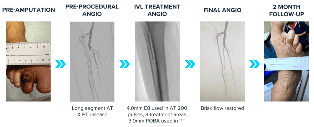 Dr. Michael Siah's E8 Case - Shockwave Medical
