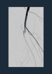 Shockwave M5+ - Shockwave Medical