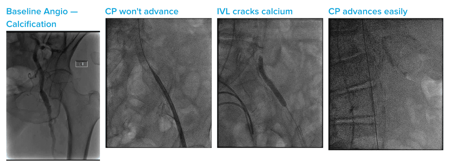Transfemoral Impella In Calcified Iliacs - Shockwave Medical