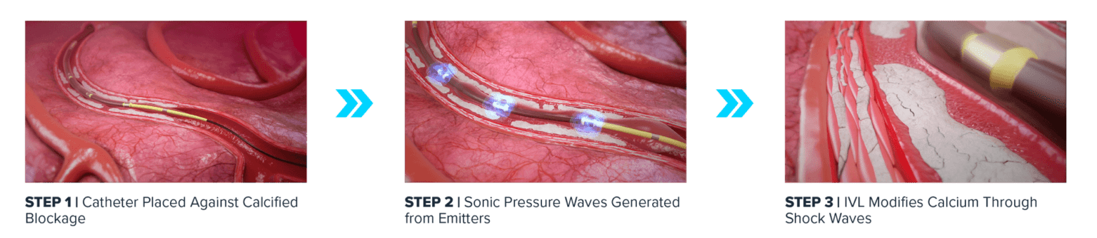 IVL Overview And MOA - Shockwave Medical