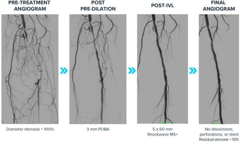 IVL Above The Knee - Shockwave Medical