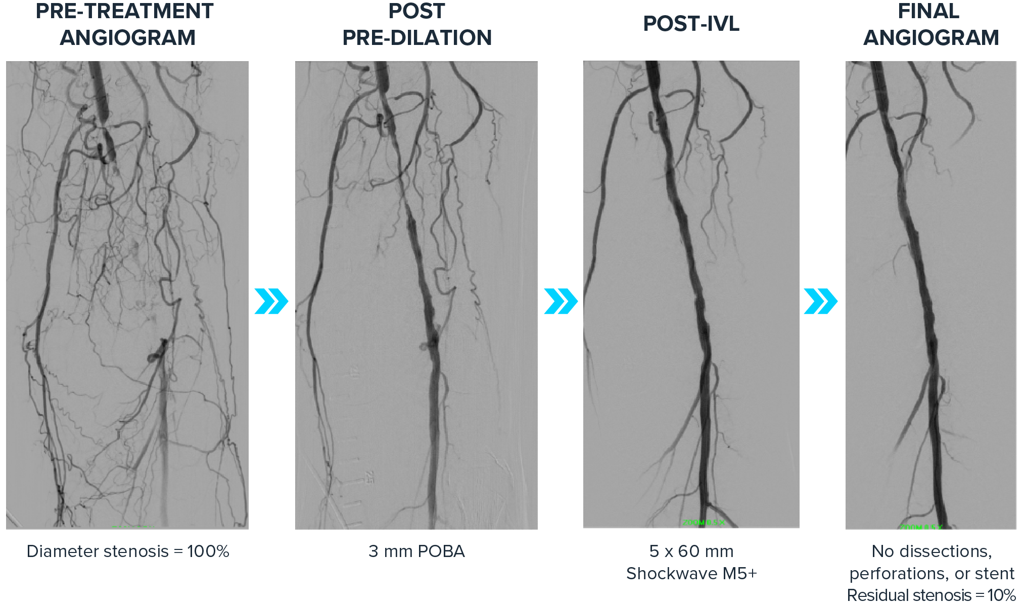 IVL Above The Knee - Shockwave Medical