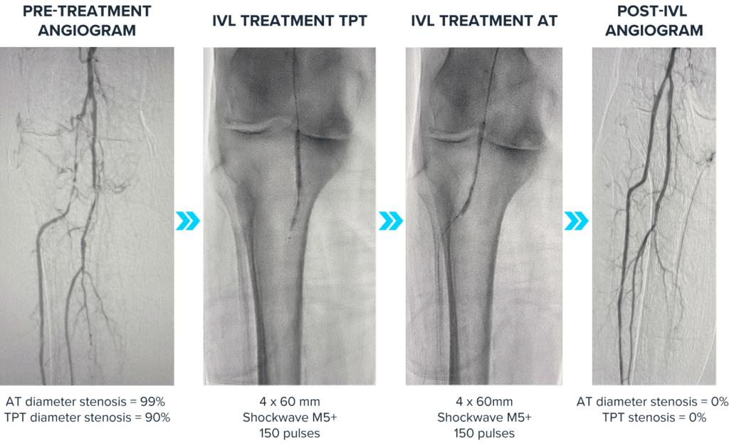 IVL Below The Knee - Shockwave Medical