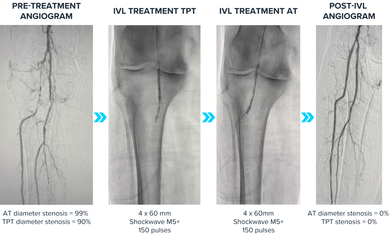 Shockwave IVL Below The Knee - Shockwave Medical