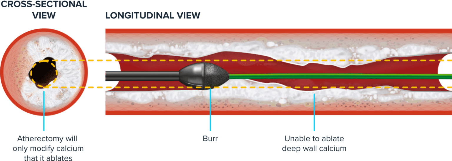 IVL & Concentric Calcium - Shockwave Medical
