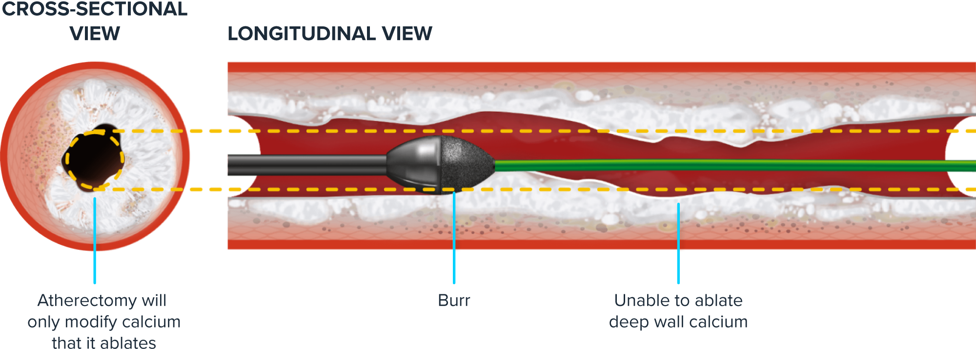 IVL & Concentric Calcium - Shockwave Medical