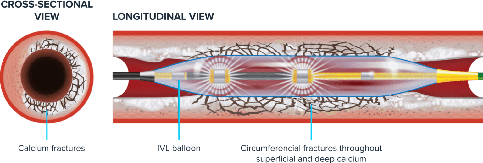 IVL & Concentric Calcium - Shockwave Medical