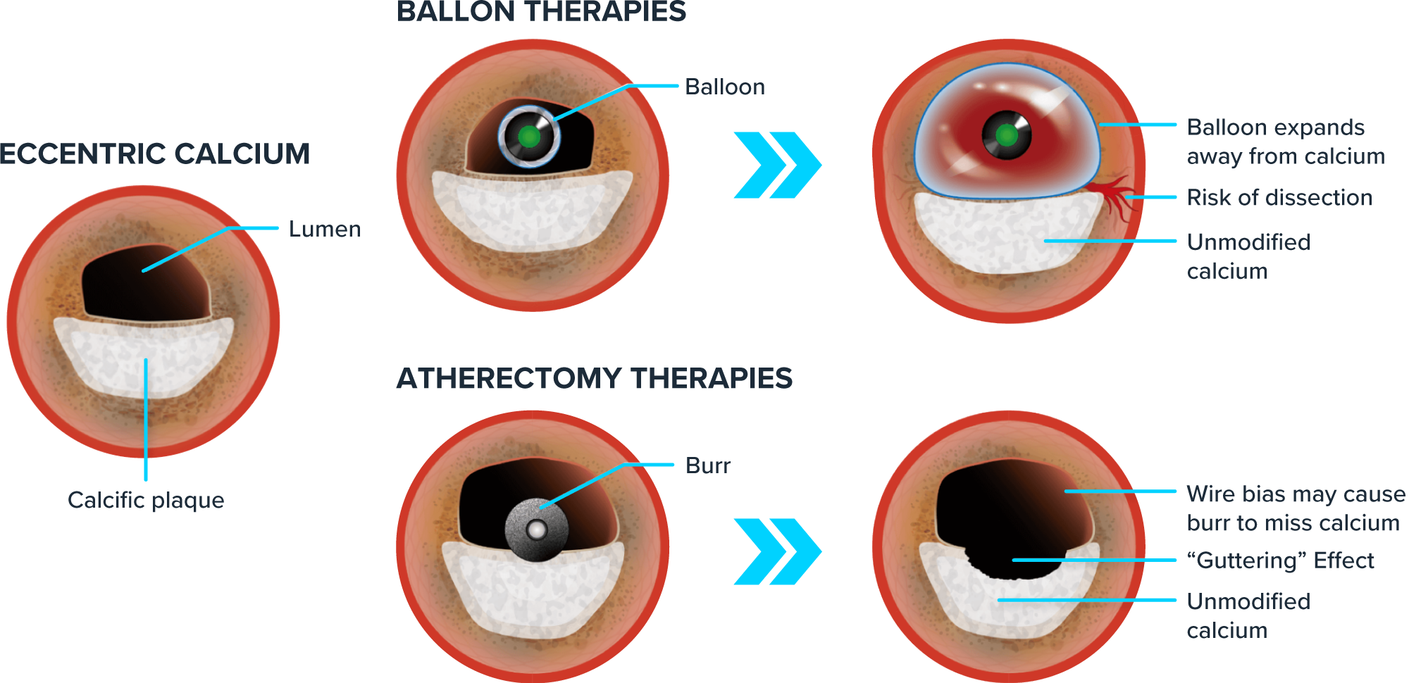 IVL & Eccentric Calcium - Shockwave Medical