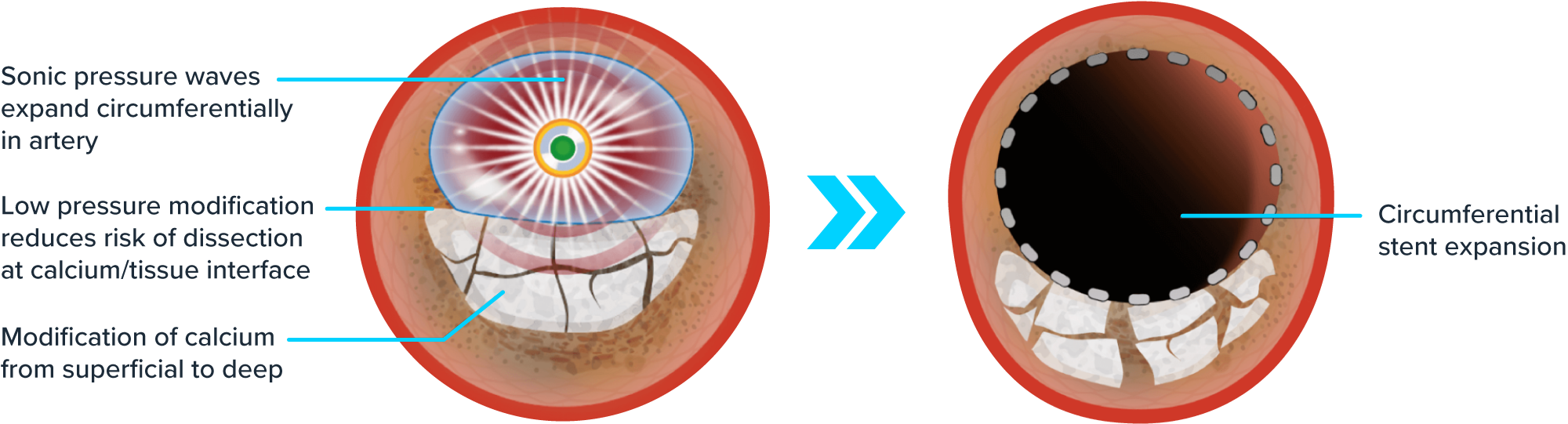 IVL & Eccentric Calcium - Shockwave Medical