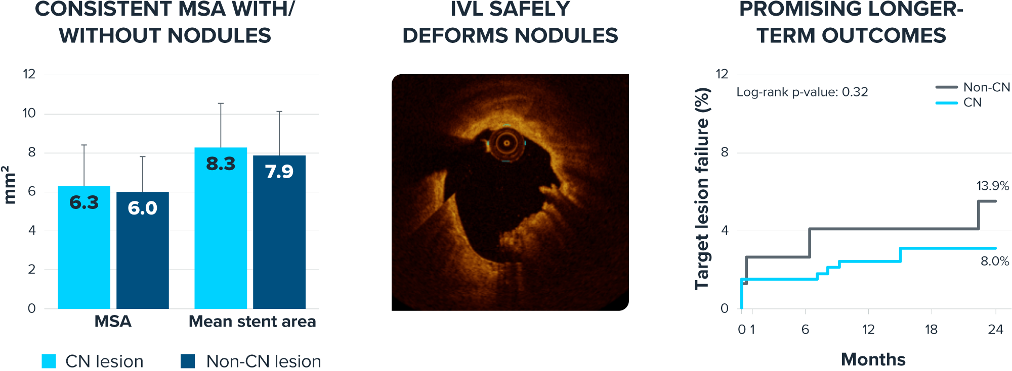 IVL & Nodular Calcium - Shockwave Medical