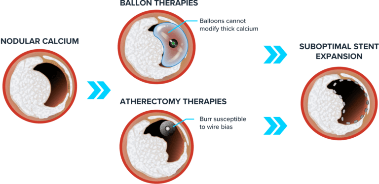 IVL & Nodular Calcium - Shockwave Medical