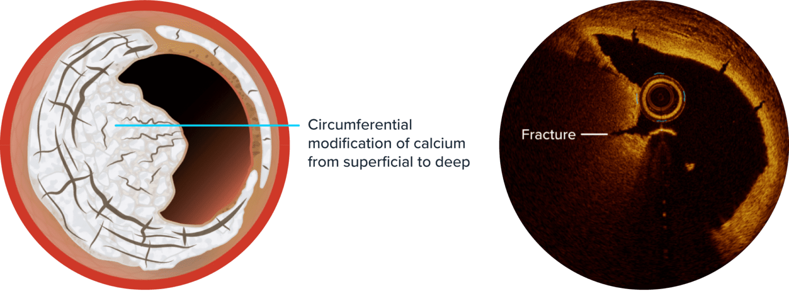 IVL & Nodular Calcium - Shockwave Medical