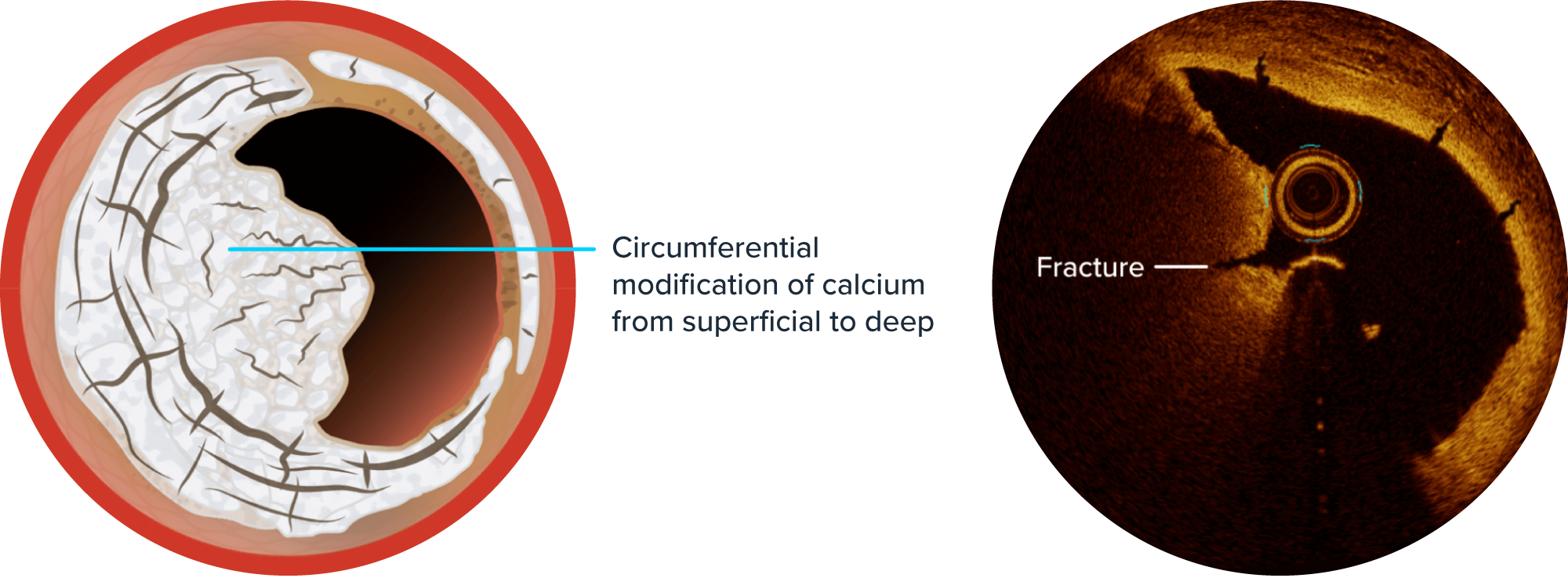 IVL & Nodular Calcium - Shockwave Medical