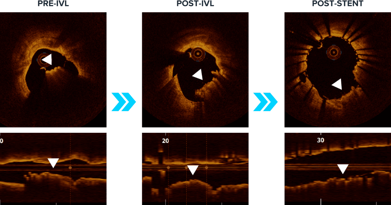 IVL & Nodular Calcium - Shockwave Medical