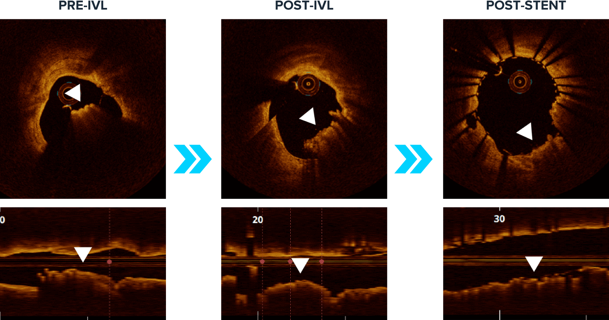 IVL & Nodular Calcium - Shockwave Medical