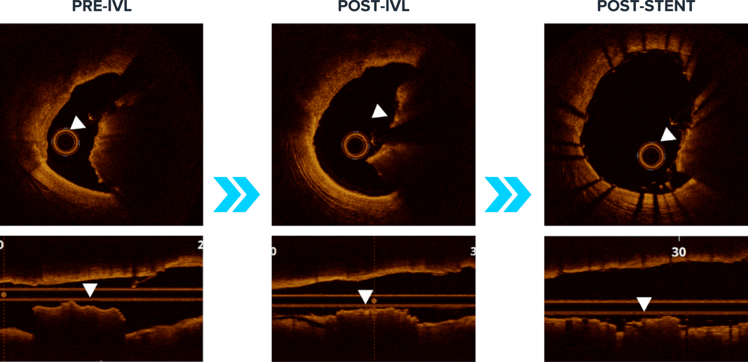 IVL & Nodular Calcium - Shockwave Medical