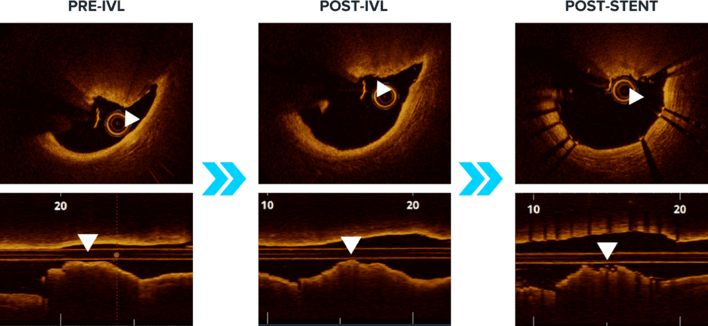 IVL & Nodular Calcium - Shockwave Medical