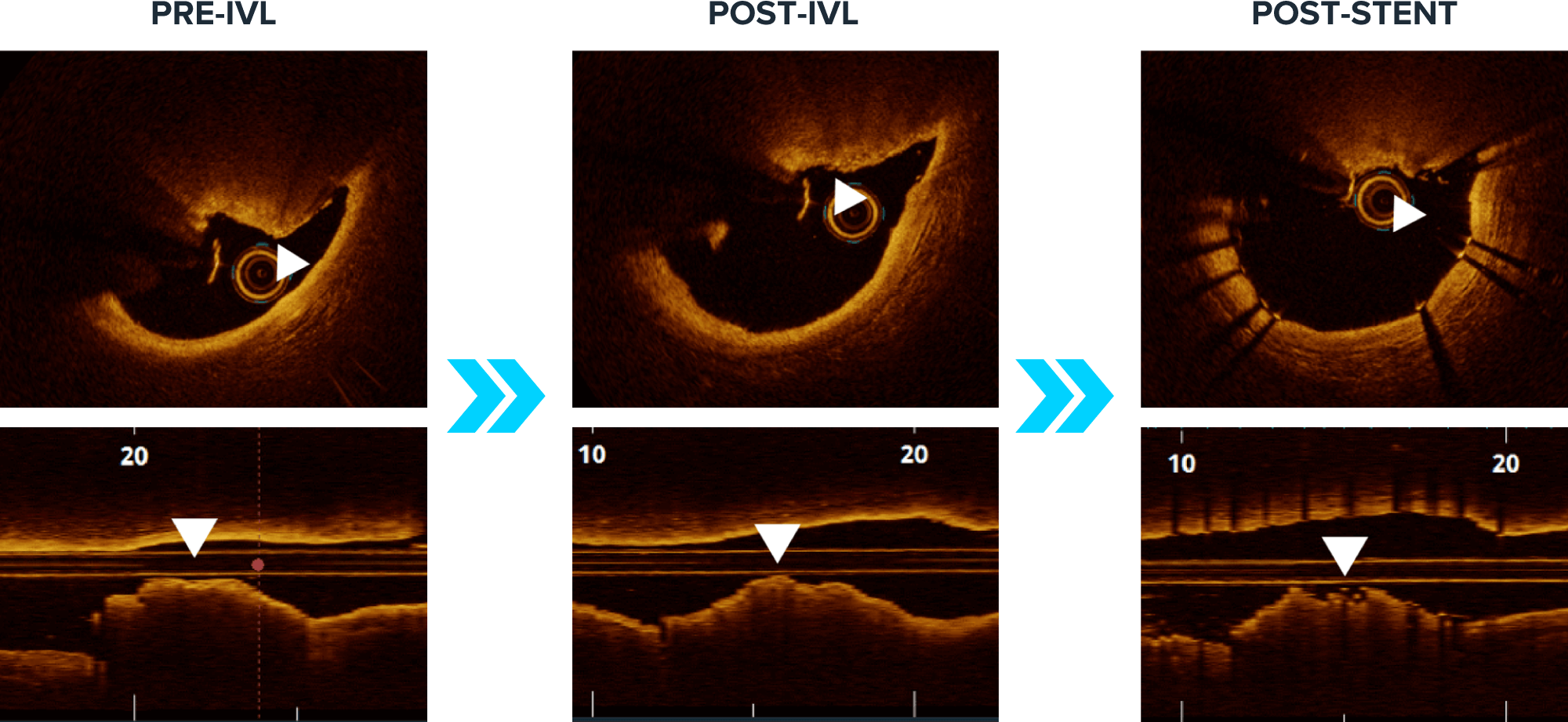 IVL & Nodular Calcium - Shockwave Medical
