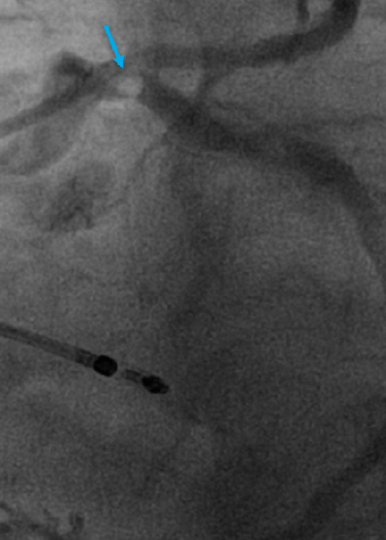 Large Focal Chunk Of Eccentric Calcium At The LCX Ostium Into The LM ...
