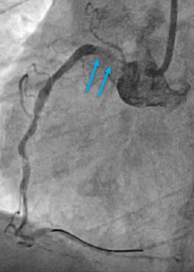 Nearly Occluded Ostial RCA That Was A Planned Rotablation Case Until ...