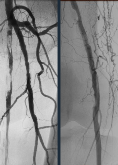 Diffuse Calcification Of SFA And Popliteal - Shockwave Medical