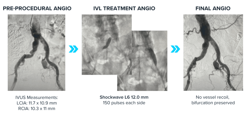 Shockwave L6 - Shockwave Medical