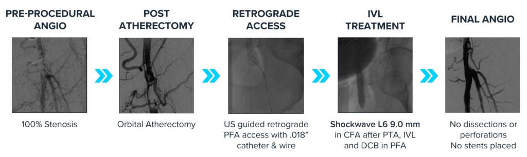 Shockwave L6 - Shockwave Medical