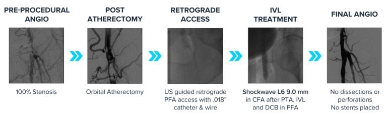 Shockwave L6 - Shockwave Medical