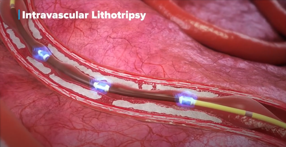 IVL Overview And MOA - Shockwave Medical