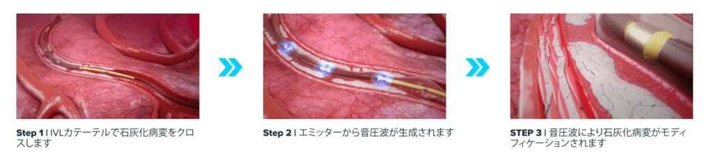 IVL Overview And MOA - Shockwave Medical