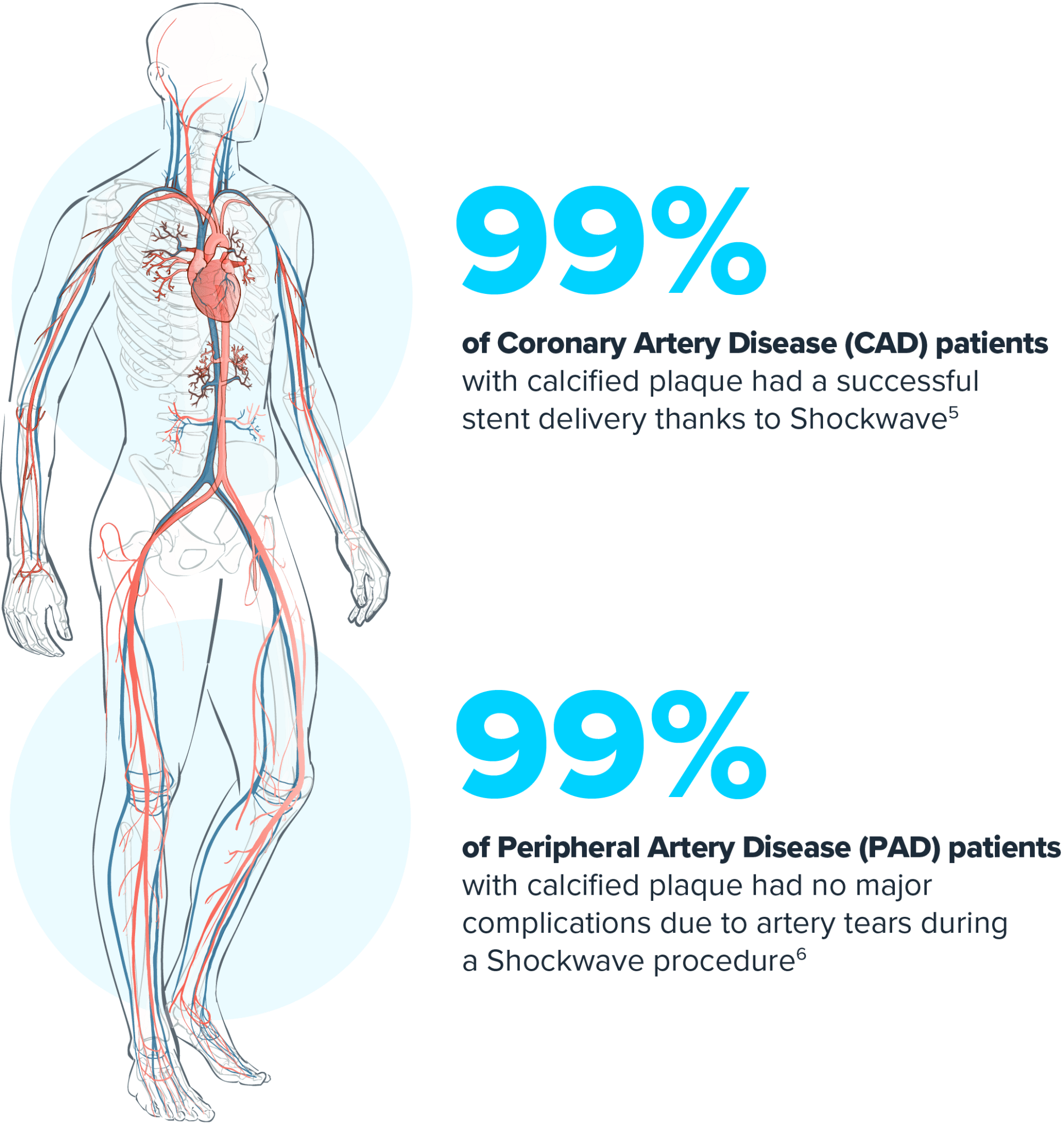 Shockwave IVL Overview For Patients - Shockwave Medical