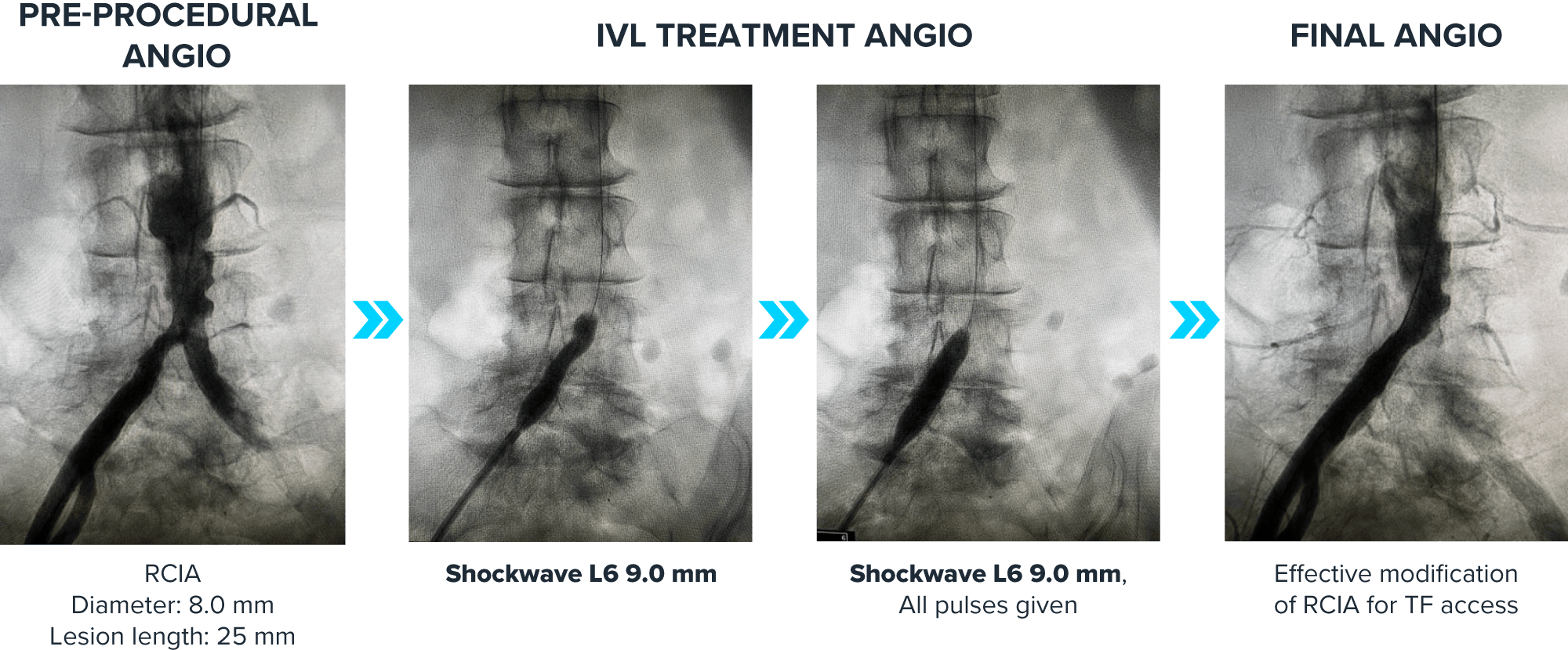 Shockwave IVL For Pre-TAVI - Shockwave Medical